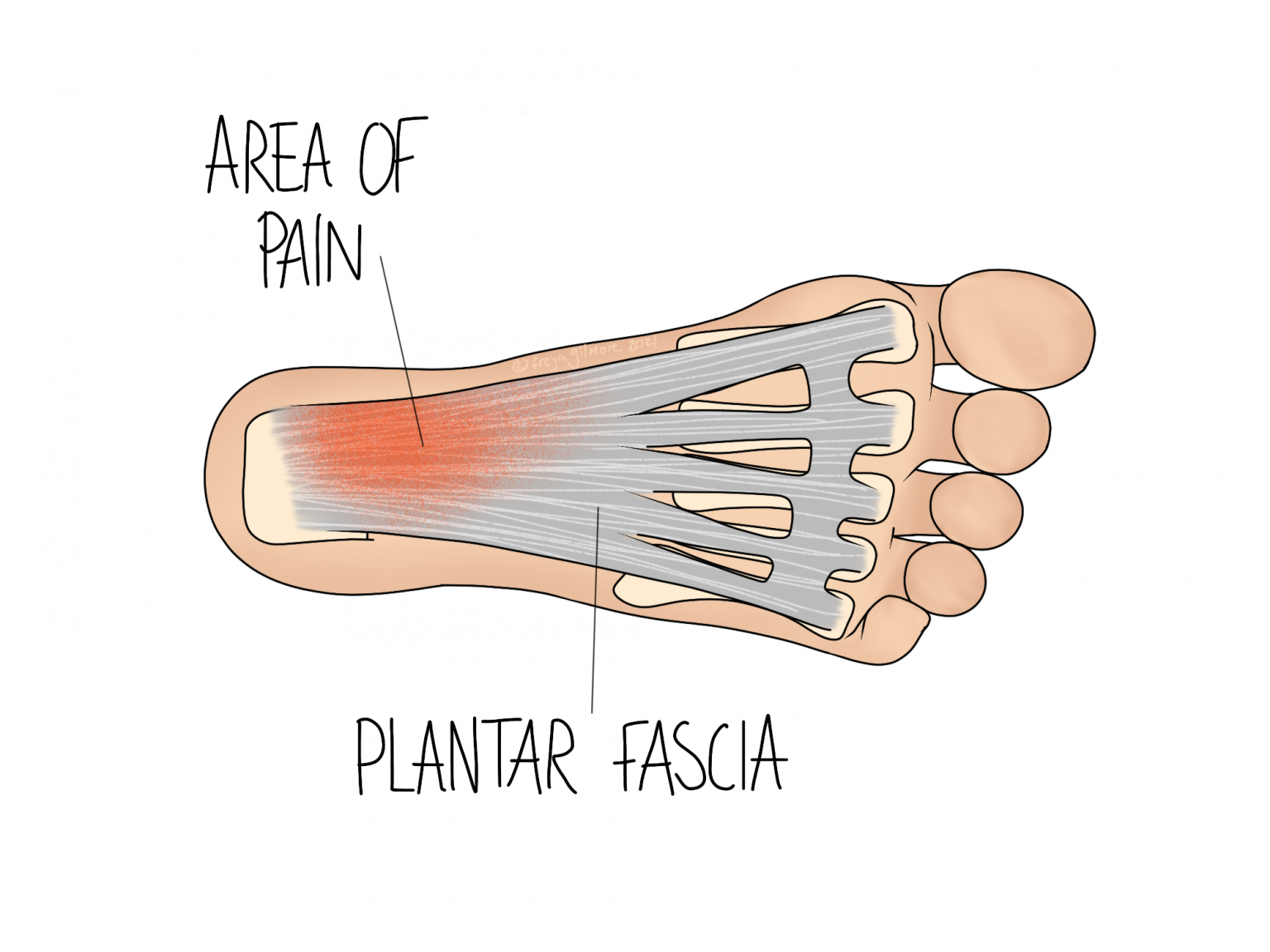 Plantar Fasciitis: A Common Cause of Foot Pain